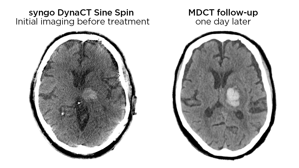Onestopinstroke - One Stop In Stroke by Neuroradiology Basel